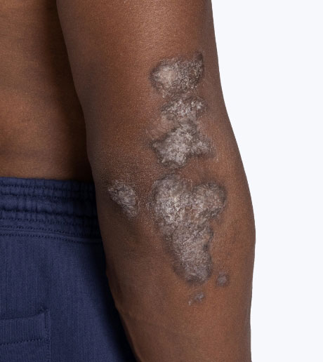 Otezla® (apremilast) Patient Profiles in PsO, PsA, and BD